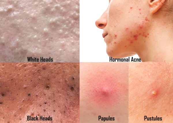 1 Different Types Of Acne And Effective Treatments - Meds For Less