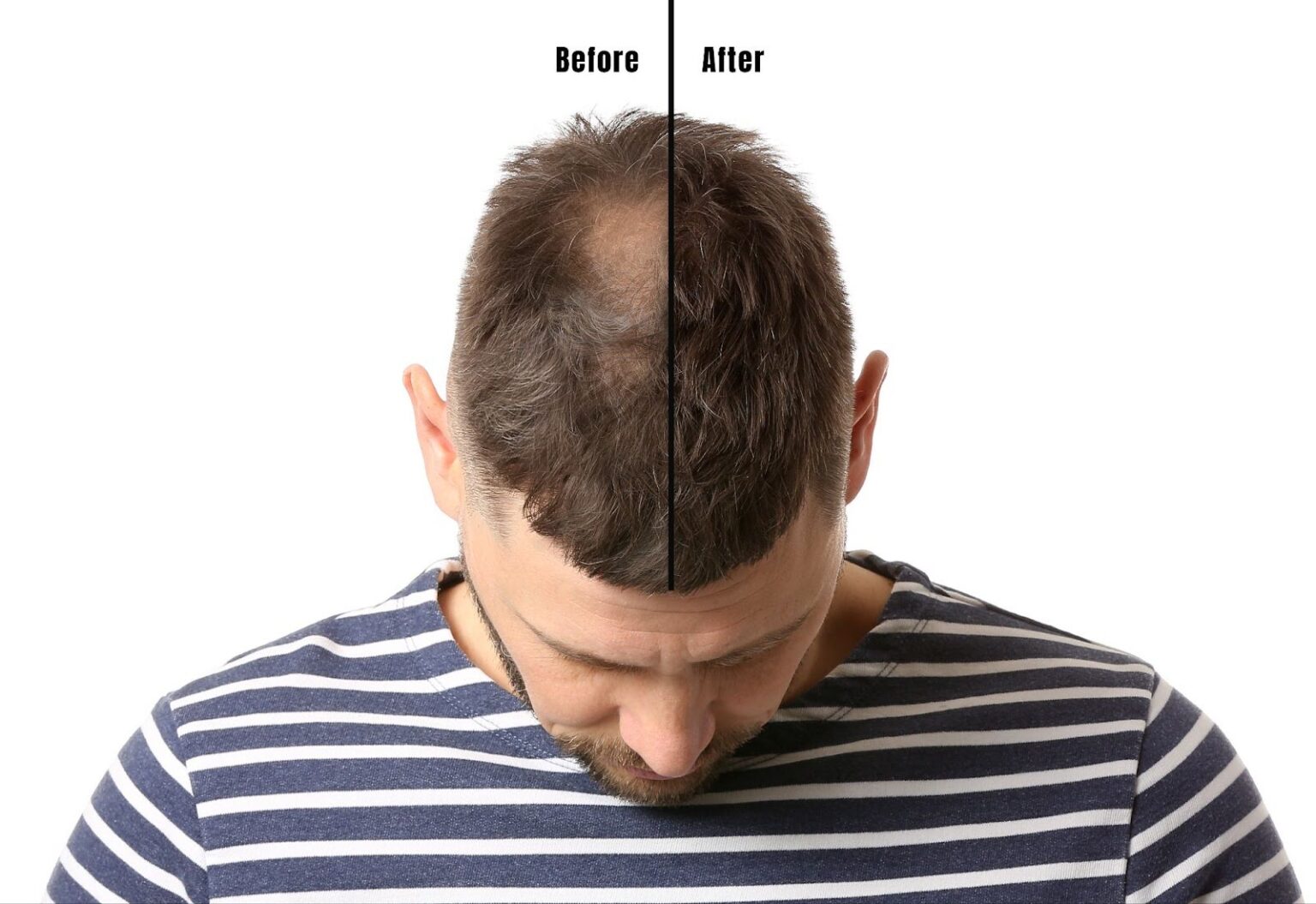 Finasteride Before And After: Timeline And Results | Blog Meds For Less