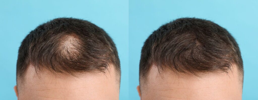 Finasteride Before And After: Timeline And Results | Blog Meds For Less