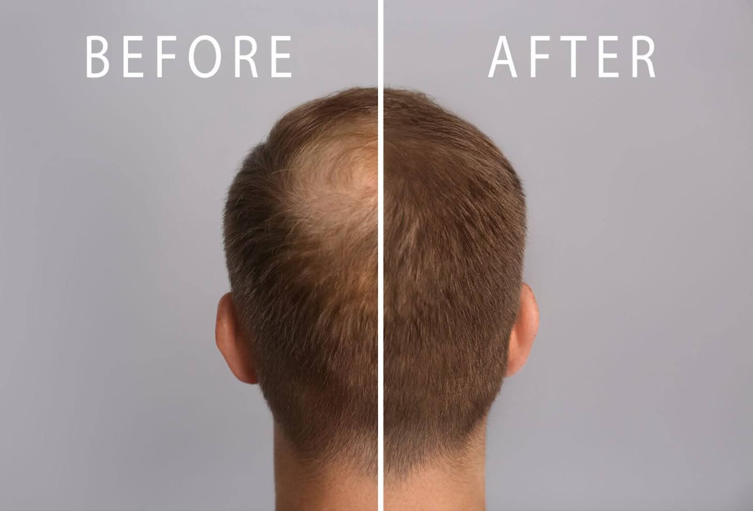 Finasteride Before And After: Timeline And Results | Blog Meds For Less