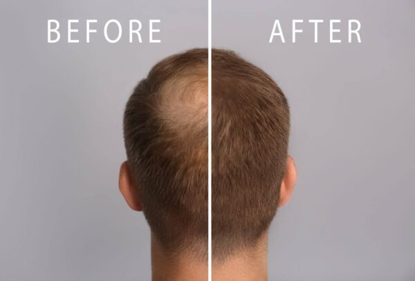 Finasteride Before And After: Timeline And Results | Blog Meds For Less